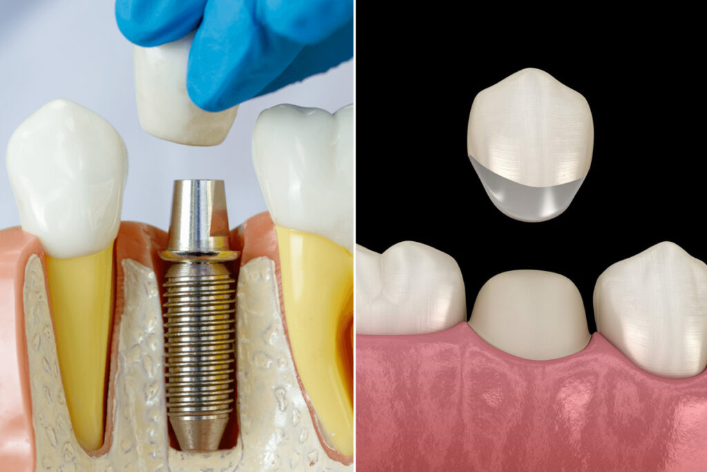 All About Dental Crowns